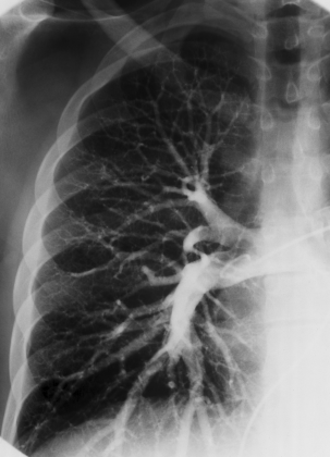MUNDO ENFERMEDADES: DIAGNÓSTICO EMBOLIA PULMONAR
