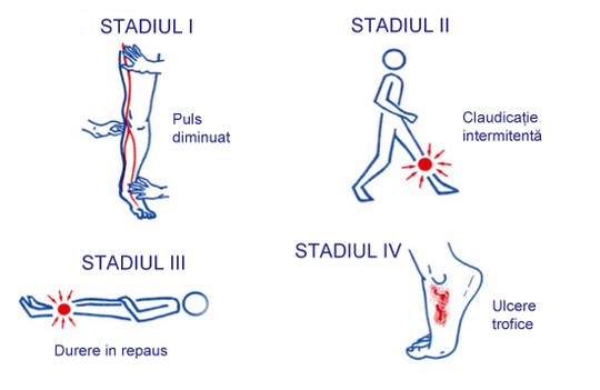 Sfaturi Utile: Arterita
