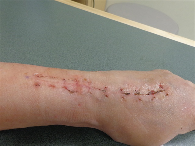 Here's Your Gold Watch - Rheutired: Wrist Fusion Surgery