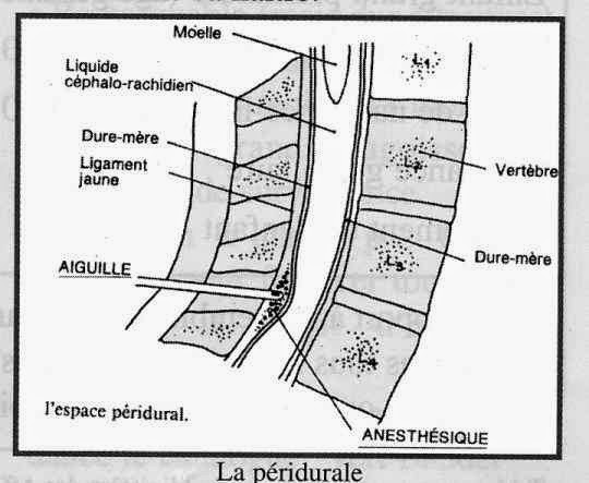 L'Anesthésie sans aucun souci ! : L'anesthésie épidurale