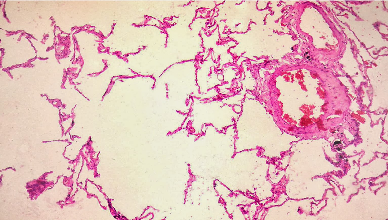 6. Emphysema pulmonis. | Pathology