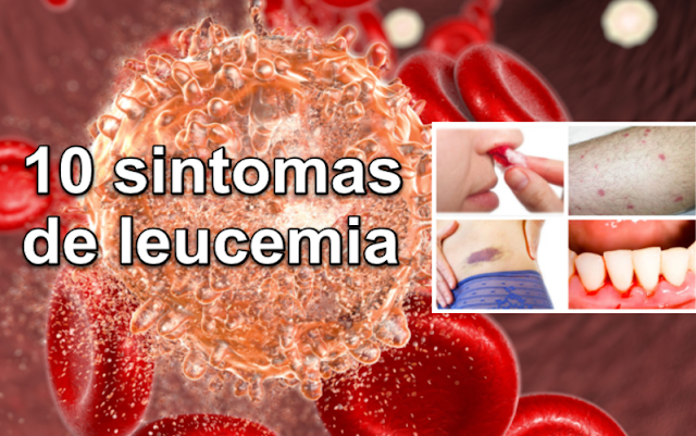10 sintomas de leucemia que são silenciosos e, portanto, são ...
