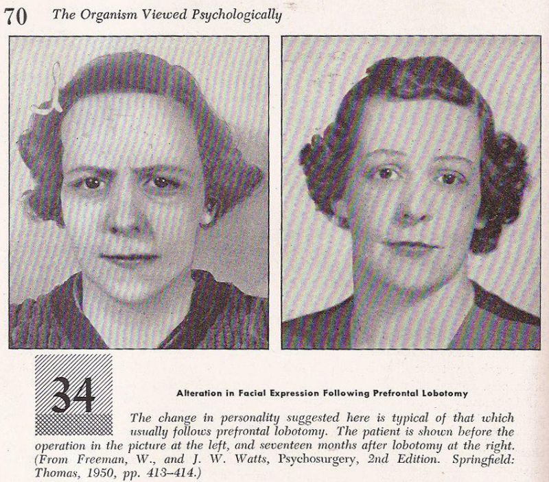 Do You Need a Lobotomy? Just Look at the Results From These Before and ...