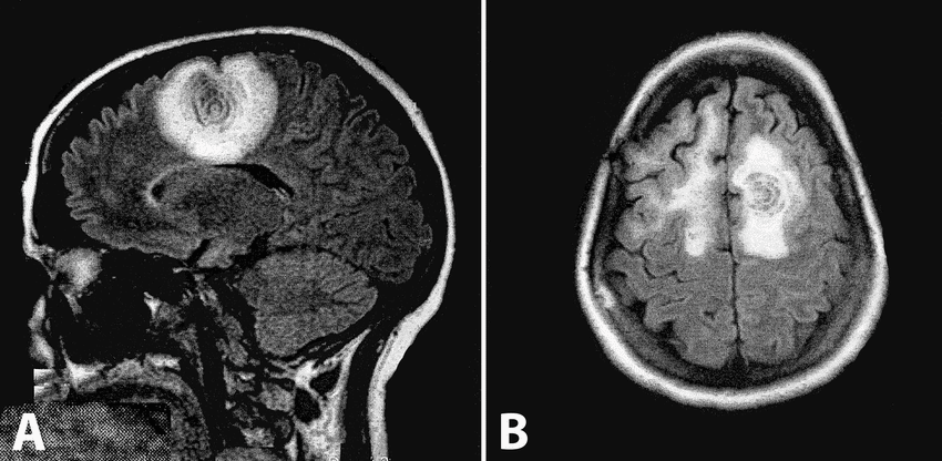 MEDIKA KEPERAWATAN: ASKEP PADA PASIEN SPACE OCCUPYING LESSION (SOL)