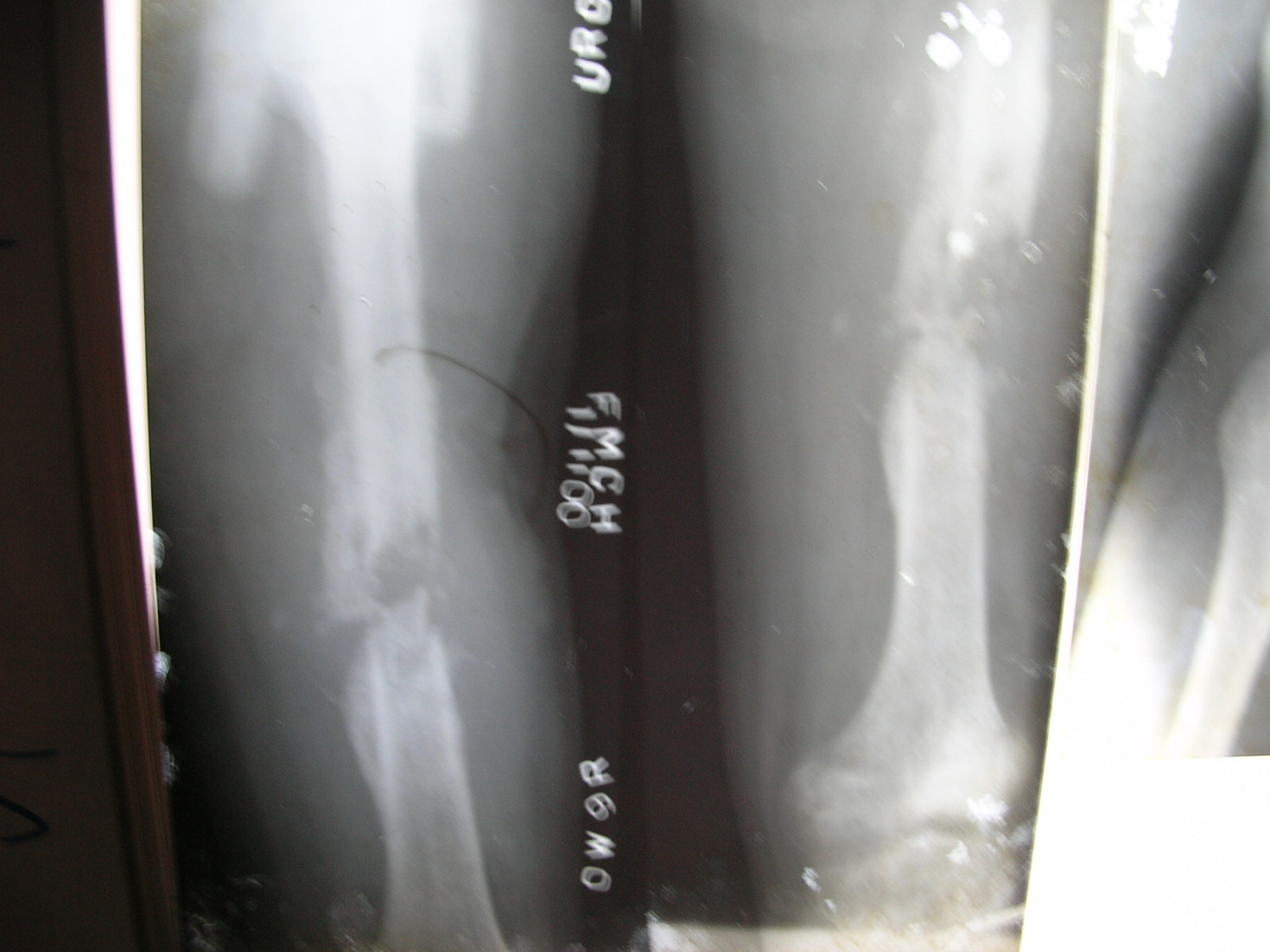 X-rays and Slides: Pathological fracture from chronic osteomyelitis
