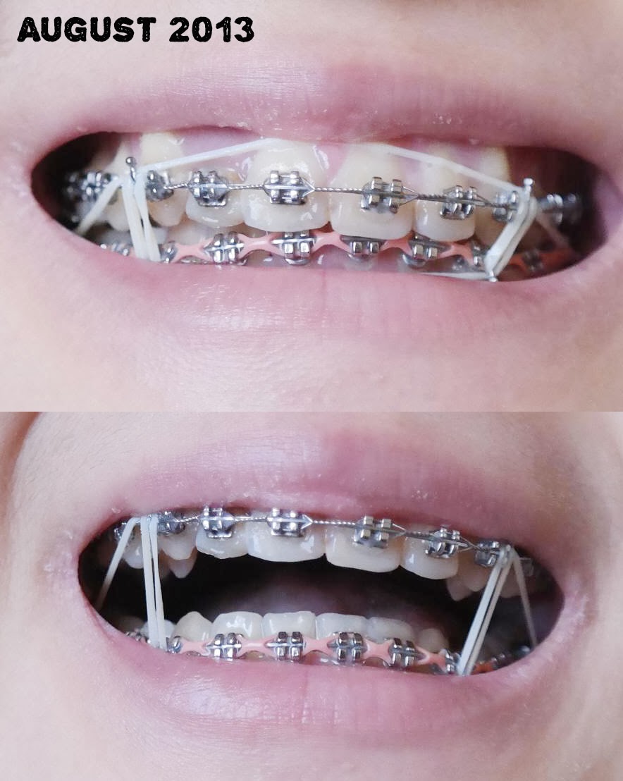 Xiao Vee: Indonesian Beauty Blogger: Diary of my braces (part 4): Year 2013