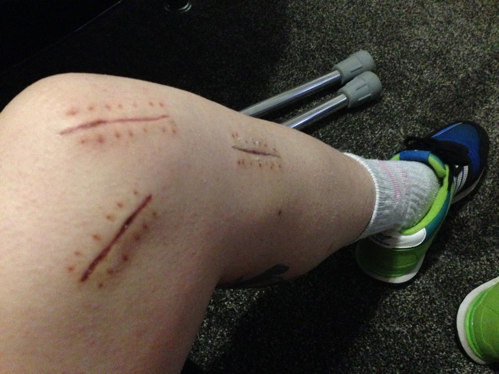 My Experience Having MPFL Reconstruction Surgery