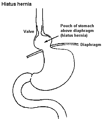 Hiatus Hernia: Hiatus Hernia Remedies