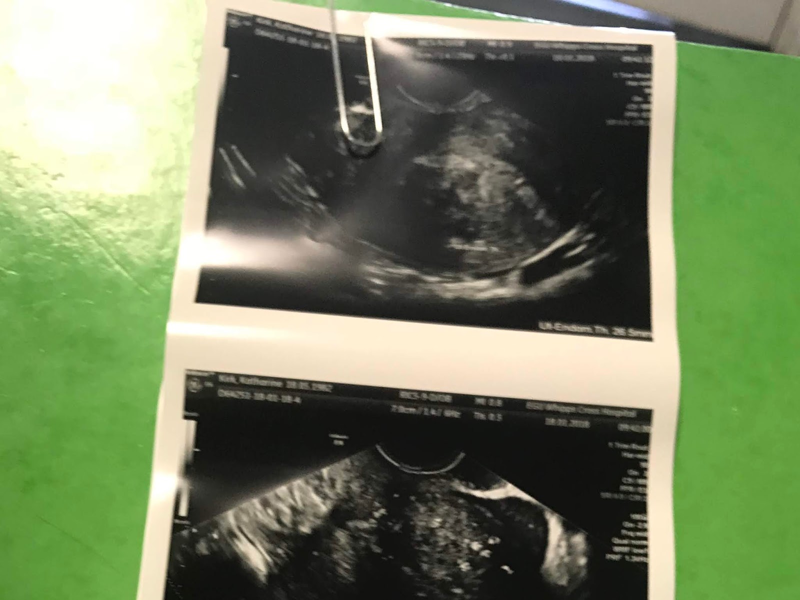 How Do I Know If I Am Having A Miscarriage? - Counting To Ten