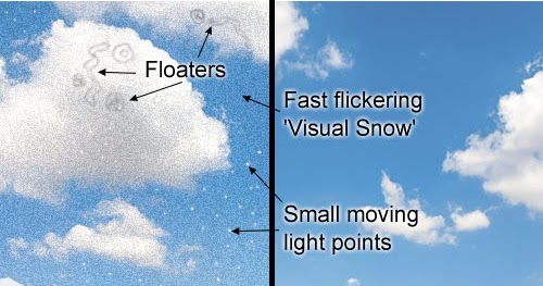 H.P.P.D. Research: Visual Snow Published Data