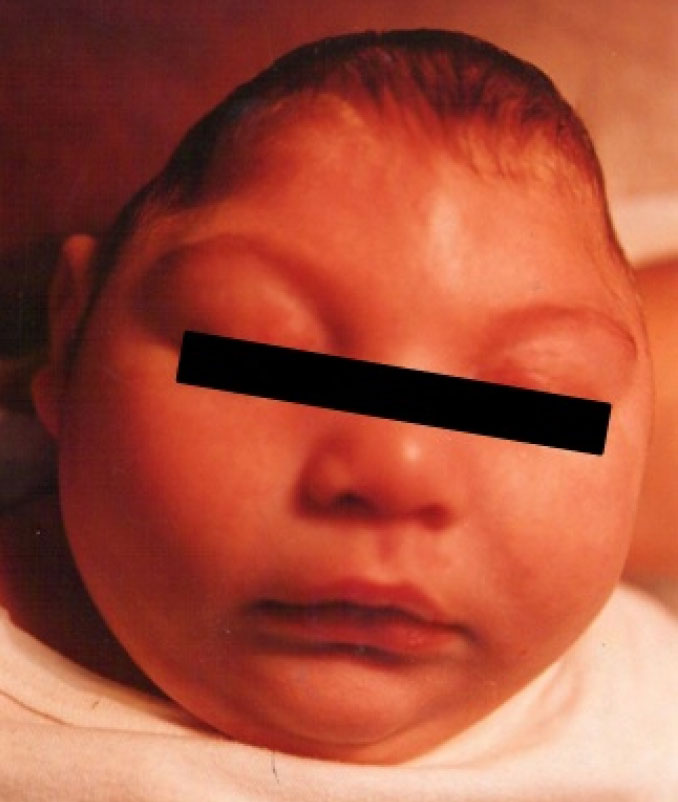 Microcefalia põe país em alerta. Ministério da Saúde decreta estado de ...