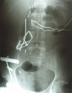 Deformutilation: Disturbing X-Rays