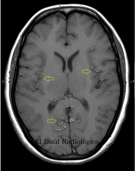 El Baúl Radiológico: 2) QUISTE DERMOIDE INTRACRANEAL (Intracranial ...