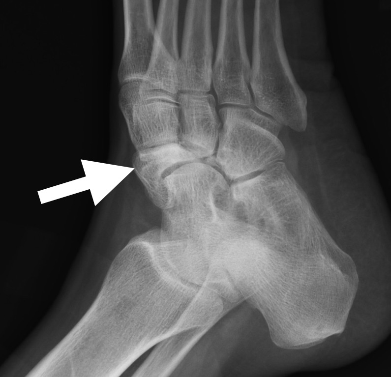 Chia-Wei Lin MD. | 林佳緯 醫師: 足部舟狀骨缺血性壞死 -- Müller-Weiss syndrome