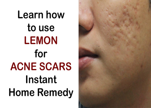 Glitzone: Lemon To Remove Acne Scars - Instant Home Remedy