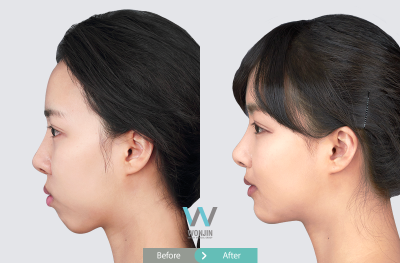 Operasi Dua Rahang, Penting untuk Memperbaiki Sisi Fungsionalnya