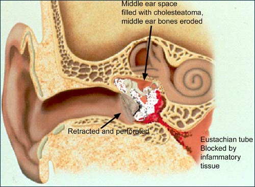 Nursing Diagnosis for Chronic Otitis Media - Acute Pain - Nursing Notes