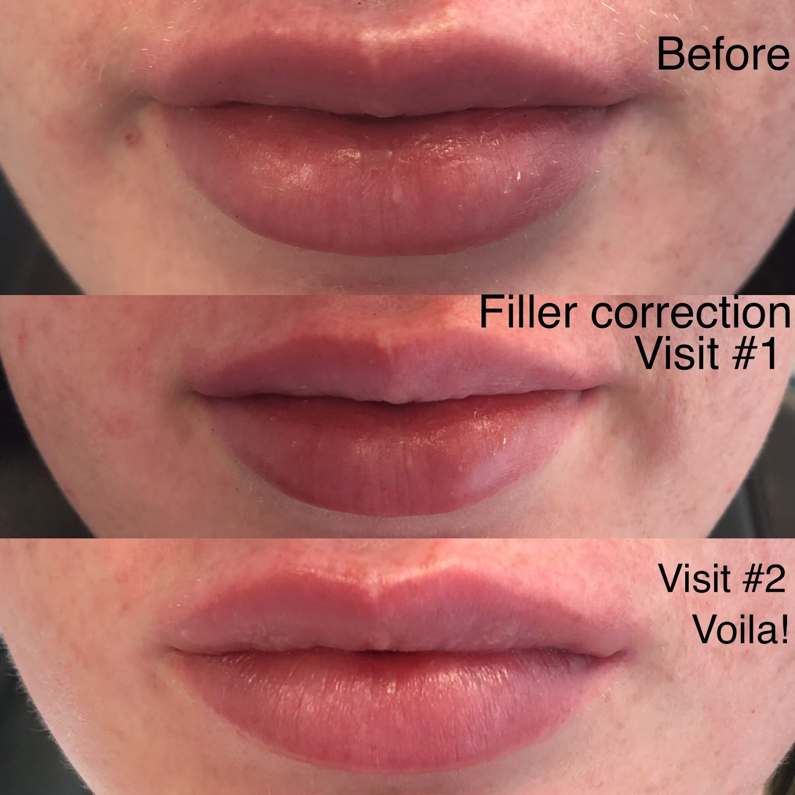 Corrective Lip Filler with Medical Injector, Sovay Reeder, in Austin!