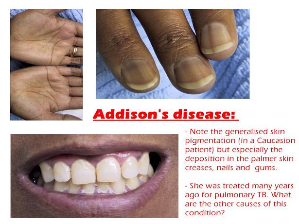 Health And Beauty Tips: Addison's Disease