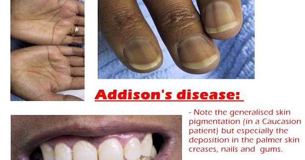 Health And Beauty Tips: Addison's Disease