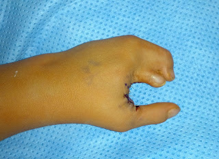 Symbrachydactyly Web Deepening | Congenital Hand and Arm Differences ...