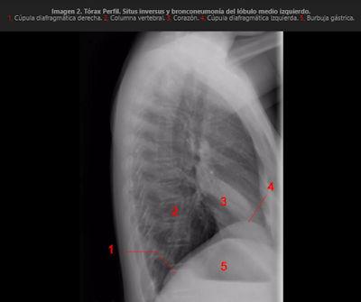 Situs Inversus: Anatomía y Radiología