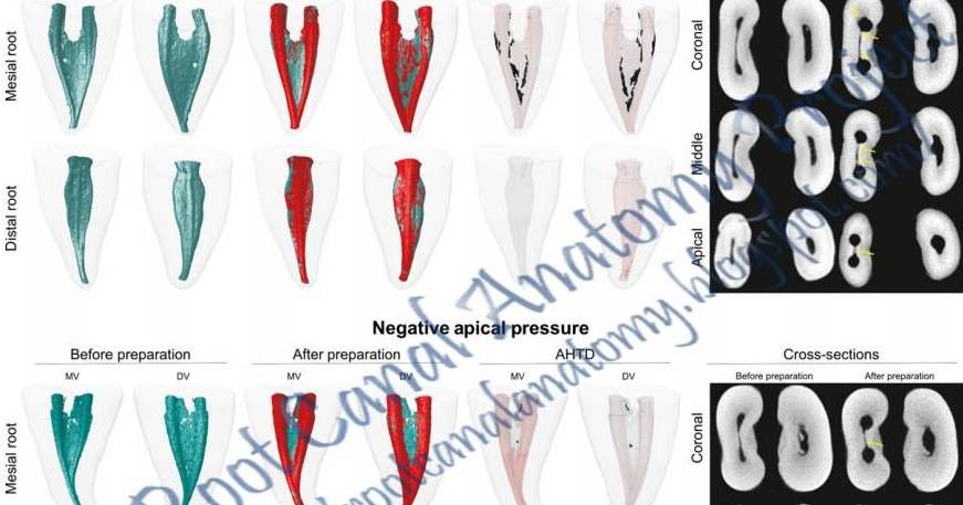 The Root Canal Anatomy Project: Publication: International Endodontic ...