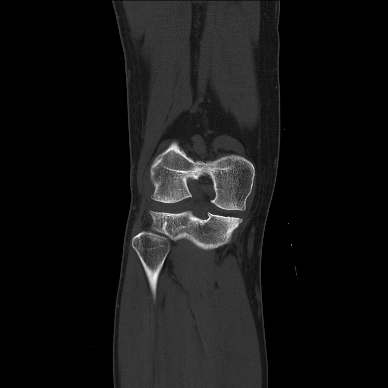 CT Knee - Radiology Imaging