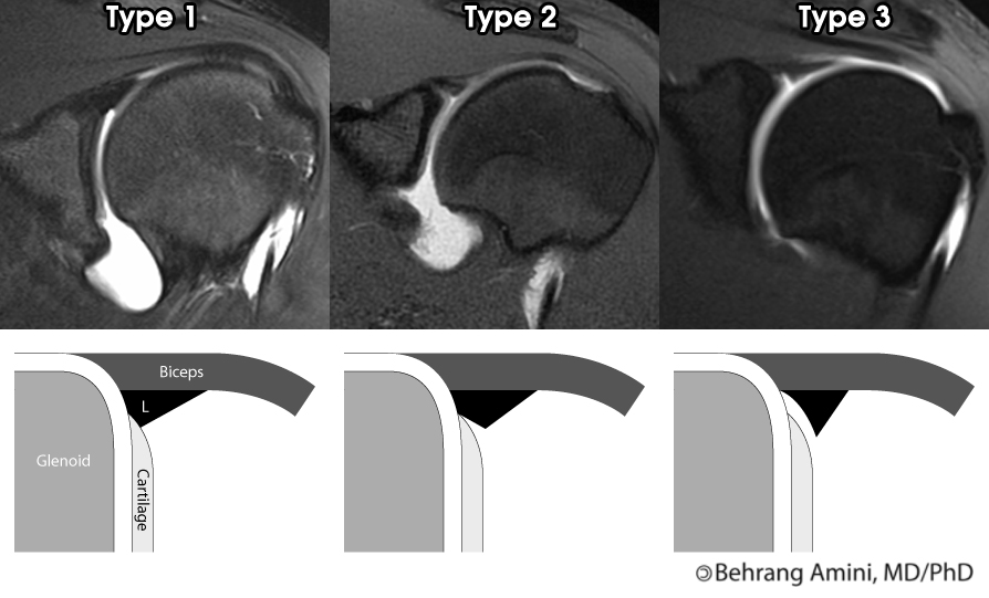 Roentgen Ray Reader: Superior Sublabral Recess