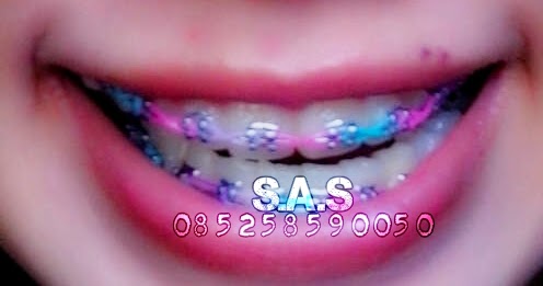 Inspirasi Baru Model Karet Behel Keramik