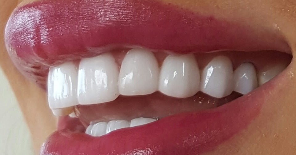 Hollywood Smile procedures, Dr Emile Medawar, 00 961 3 379355: Smiles ...