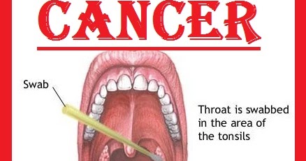 throat cancer info: what is throat cancer
