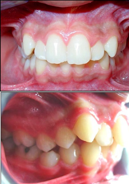 MALOCLUSIONES CLASE I