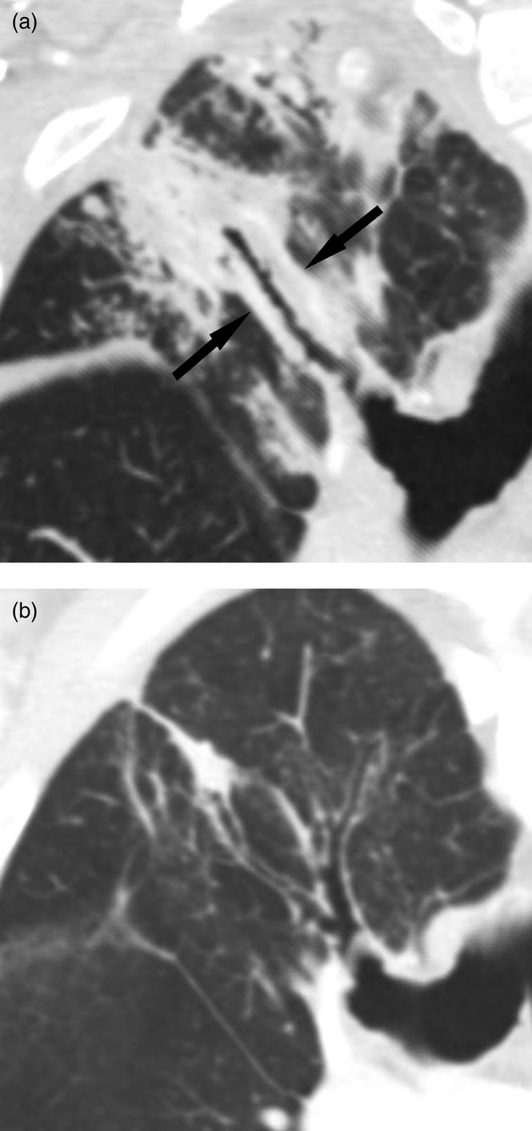 Chest Section: 5-3-Diffuse reticular pattern: