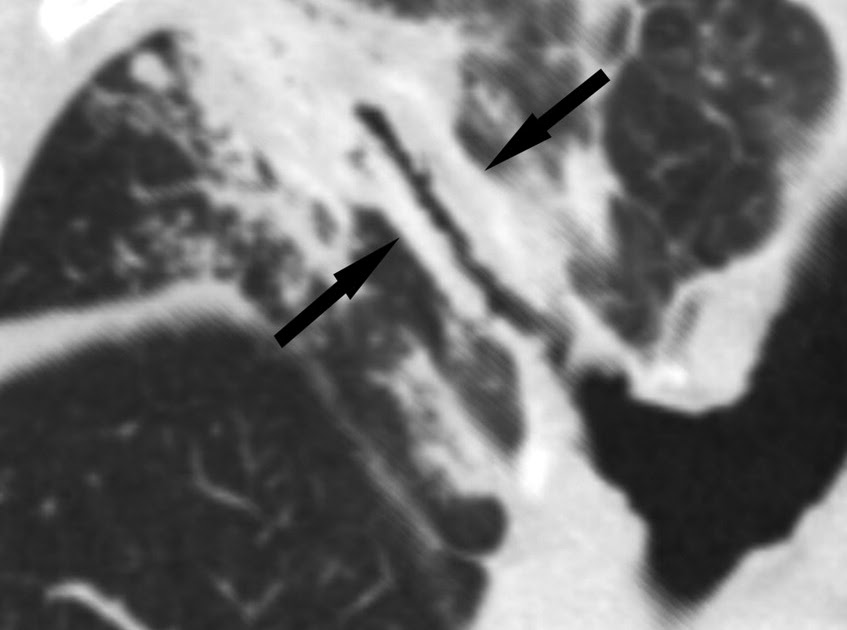 Chest Section: 5-3-Diffuse reticular pattern: