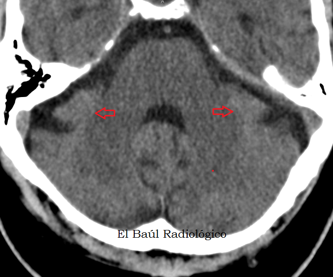 El Baúl Radiológico: LÓBULO FLOCULONODULAR CEREBELOSO. (The Cerebellar ...