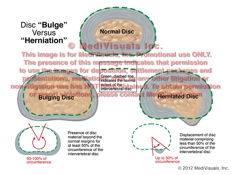The Medical Legal Exhibit Expert Blog: How a Disc "Bulge" is Different ...