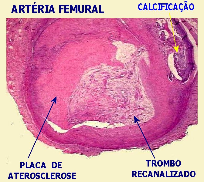 Liga de Patologia - UFC: ATEROSCLEROSE