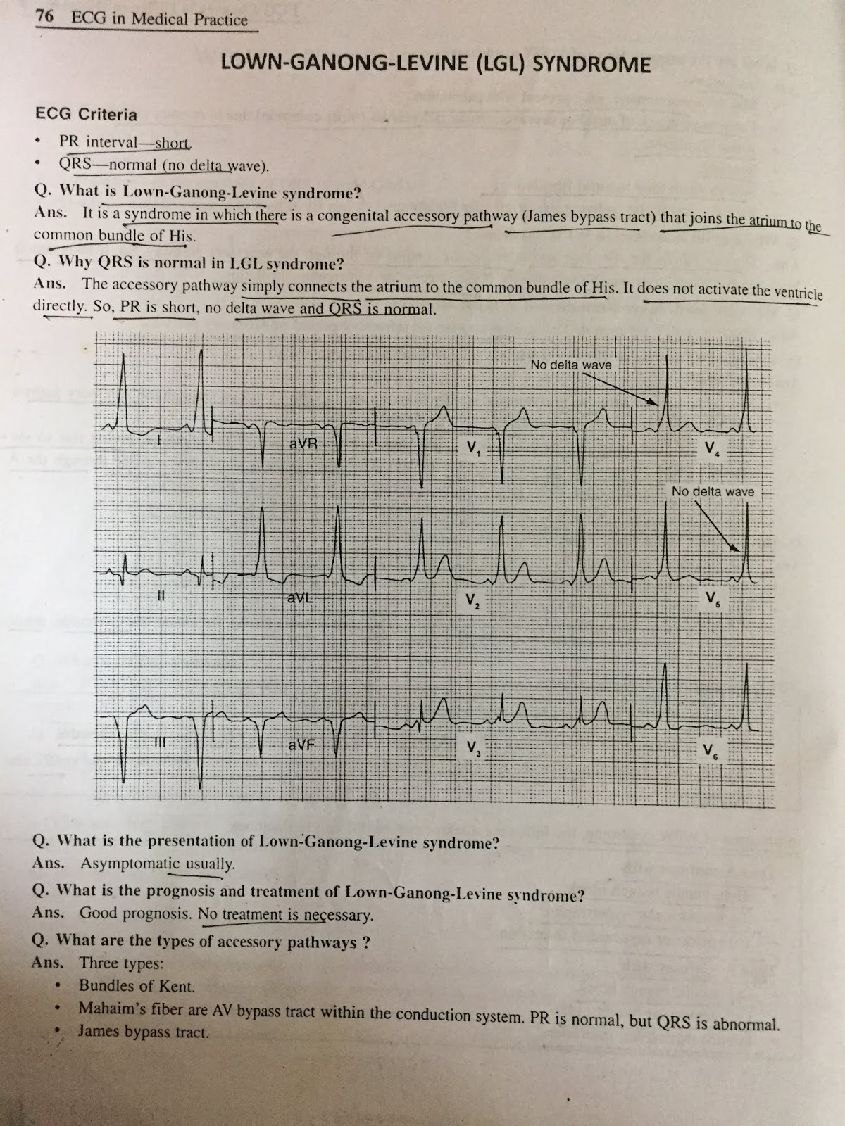 ECG LGL SYNDROME AND SINUS ARRYTHMIA