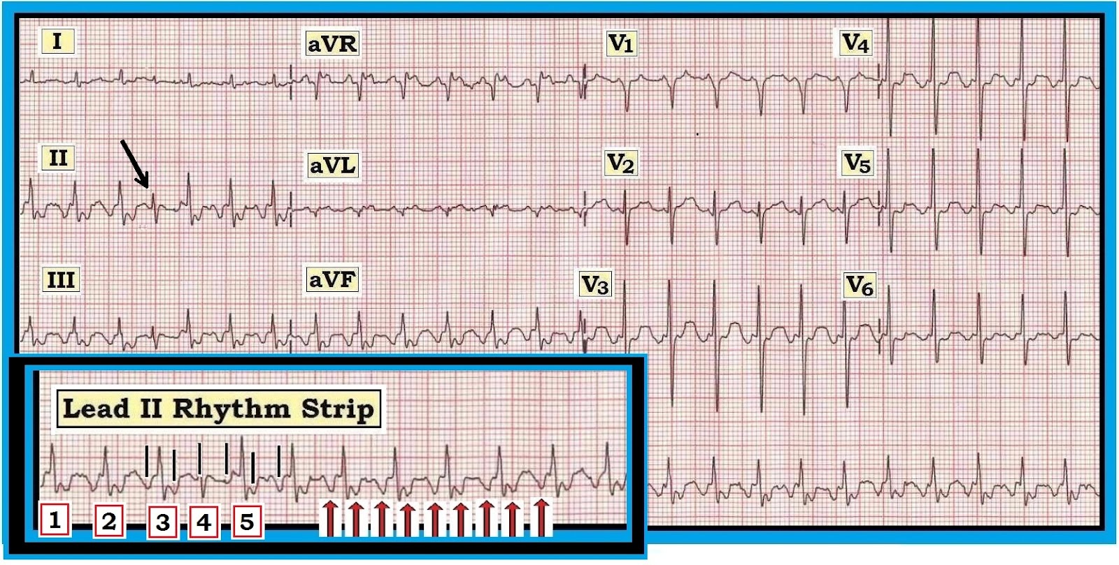 ECG Interpretation: ECG Interpretation Review #40 (Regular SVT - List 1 ...