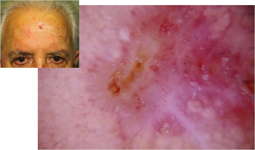 Dermatoscopia: Ulceration