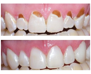 Restauración estética dental: Resina o composite dental