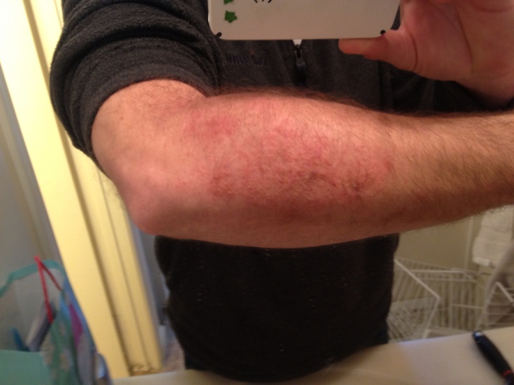 Control de Plagas en Sanidad Ambiental: Dermatitis por contacto con ...