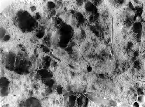Centriacinar / Centrilobular emphysema