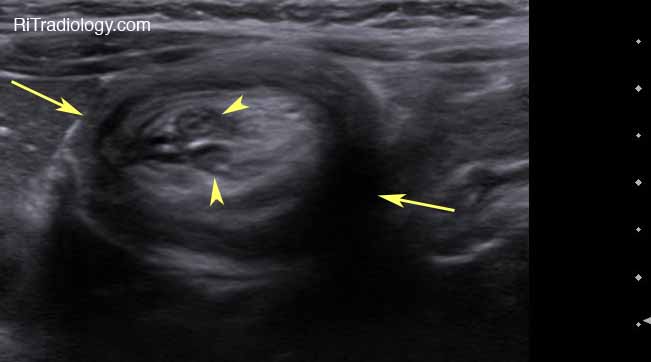 RiT radiology: Intussusception: Ultrasound