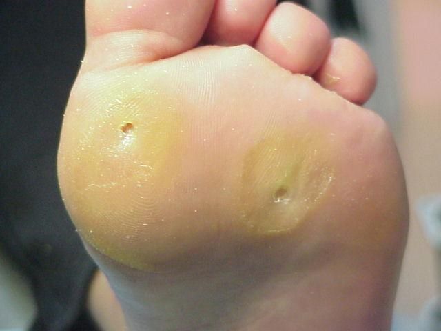 Diferencia entre Heloma y Verruga :: Fisioterapia.Kinesiologìa ...