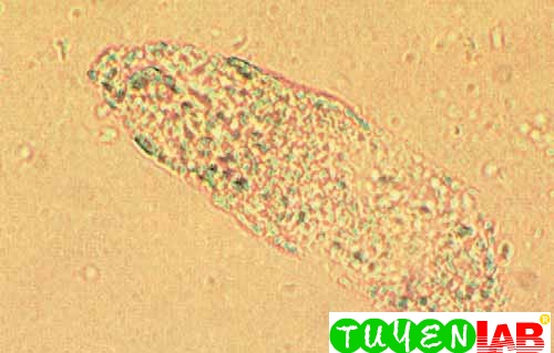 Atlas of Casts in urine | Free Medical Atlas