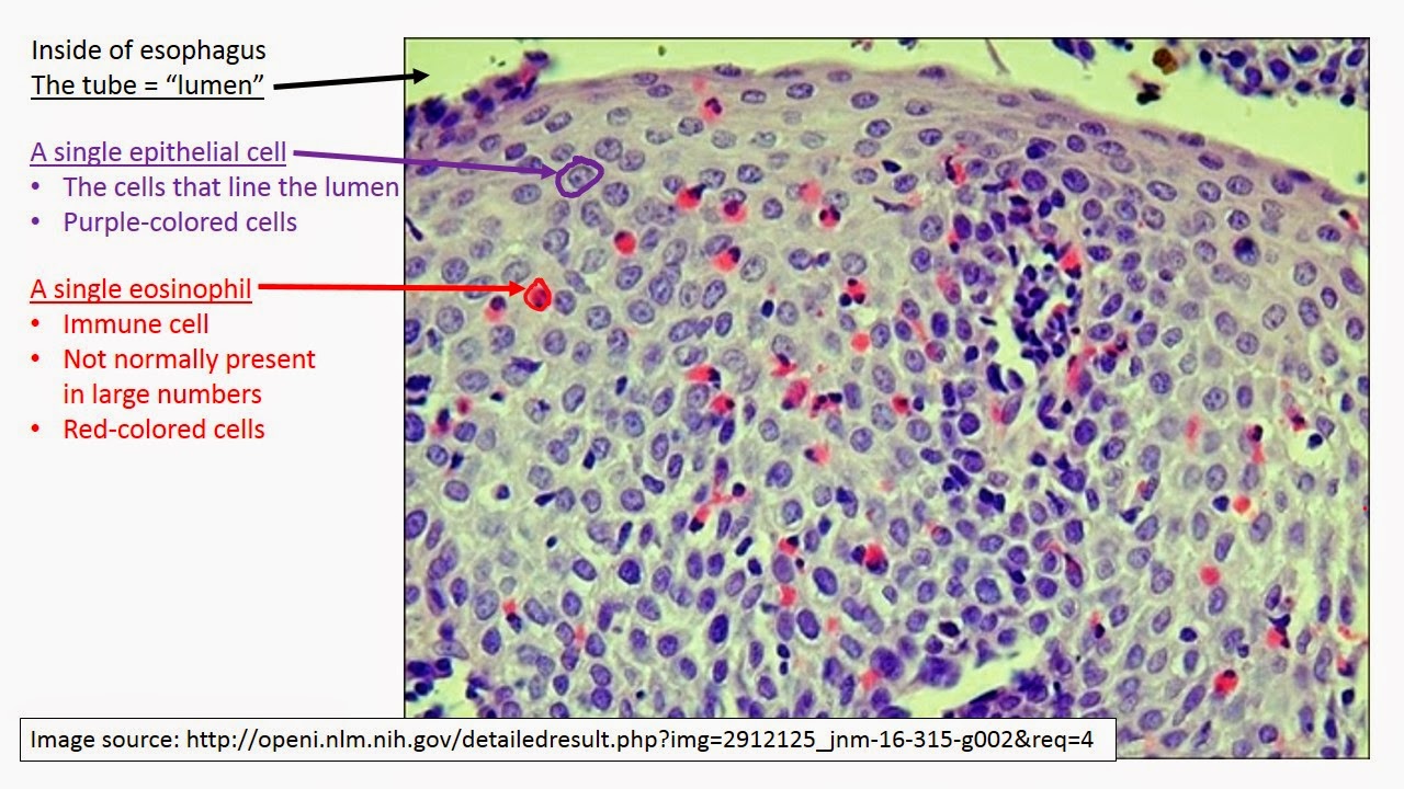Food Allergy Sleuth: Eosinophilic Esophagitis - Scientific Excitement ...