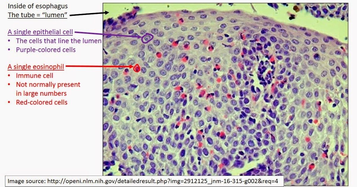 Food Allergy Sleuth: Eosinophilic Esophagitis - Scientific Excitement ...
