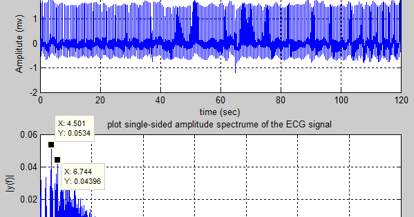 Biomedical Signal and Image Processing projects using Matlab and Labview tools: Matlab code to ...
